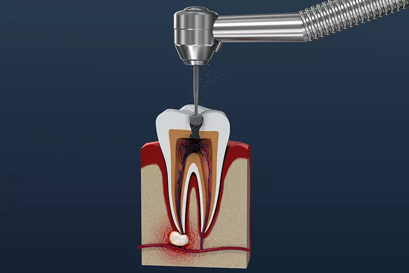Dental Emergency Burke VA | Same Day Appointments | Book Now