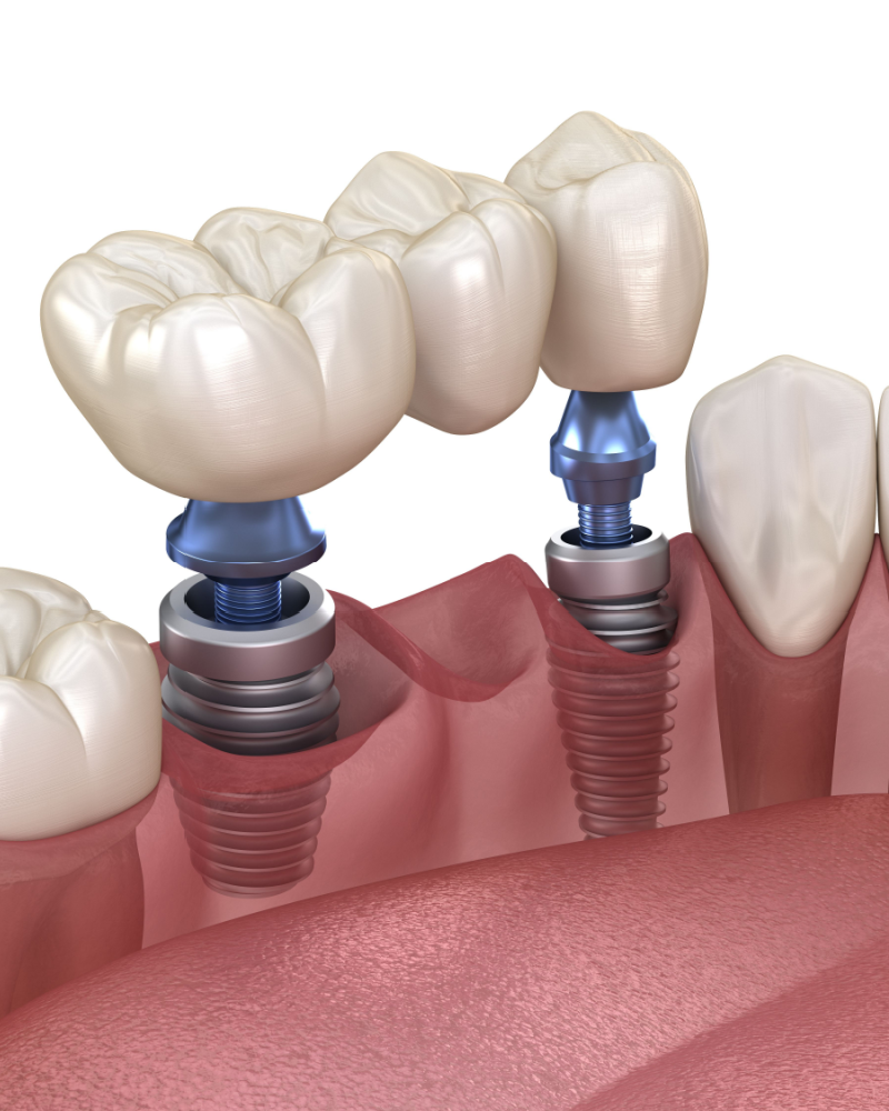 High Quality Dental Bridge in Burke VA - Call (703) 250-5072